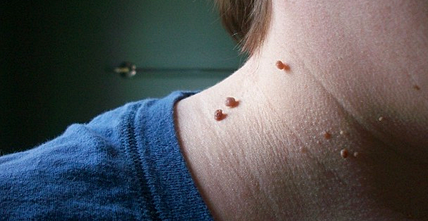 There's an easy and painless way to get rid of skin tags! It isn't ...